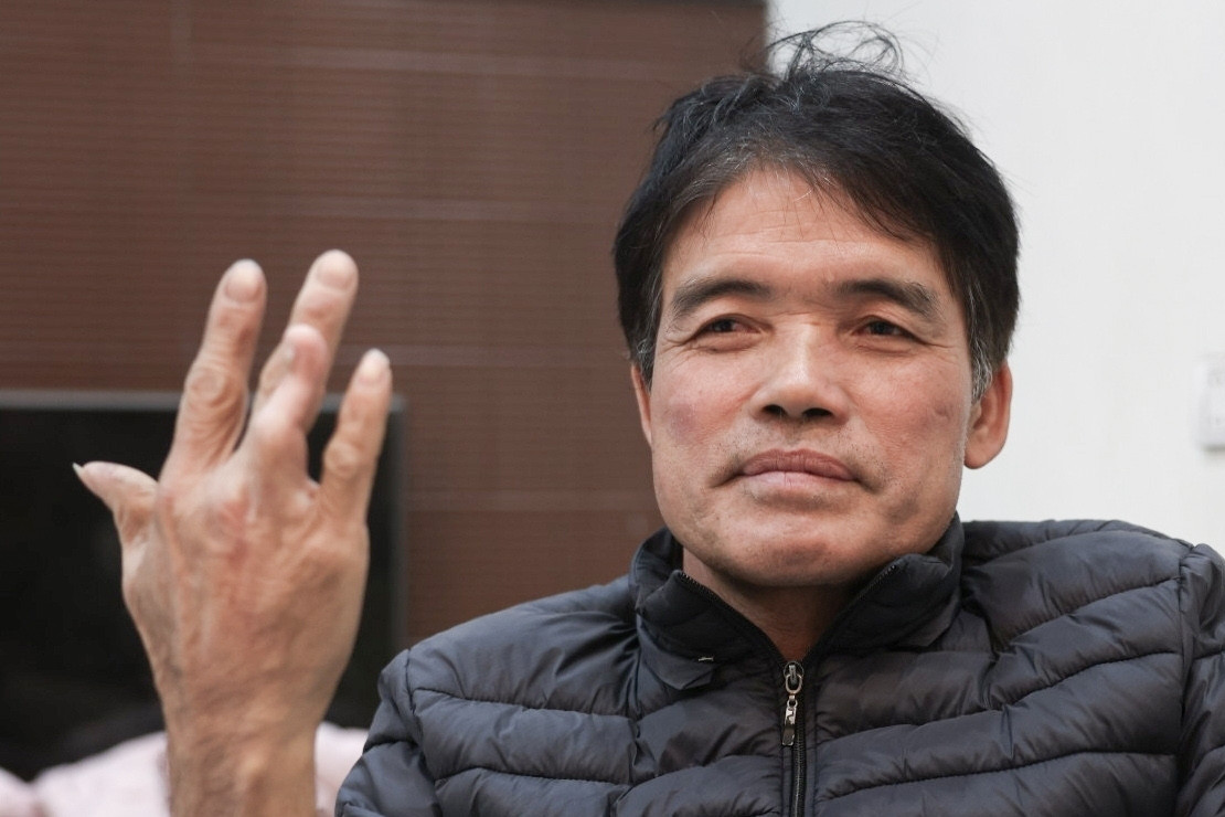 Đôi bàn tay thiếu ngón 'hé lộ' sự thật rợn người ở làng nuôi rắn hổ mang