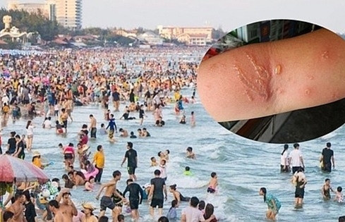 Người đàn ông bỏng rát toàn bộ chân trái sau 15 phút tắm biển